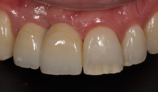 An Interdisciplinary Approach to a Complex Anterior Implant Case